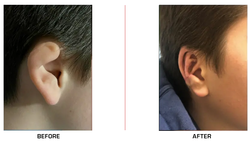 Otoplasty | Best Surgeon | Ear Surgery NYC - Ear Reconstruction Gallery