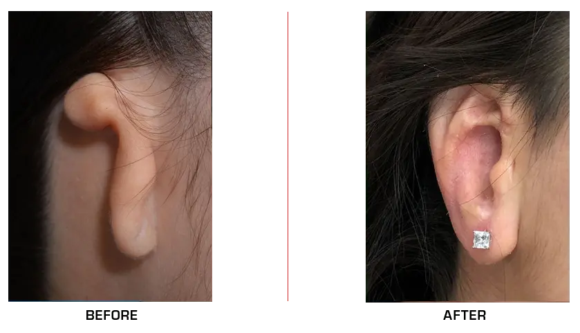 Otoplasty | Best Surgeon | Ear Surgery NYC - Ear Reconstruction Gallery